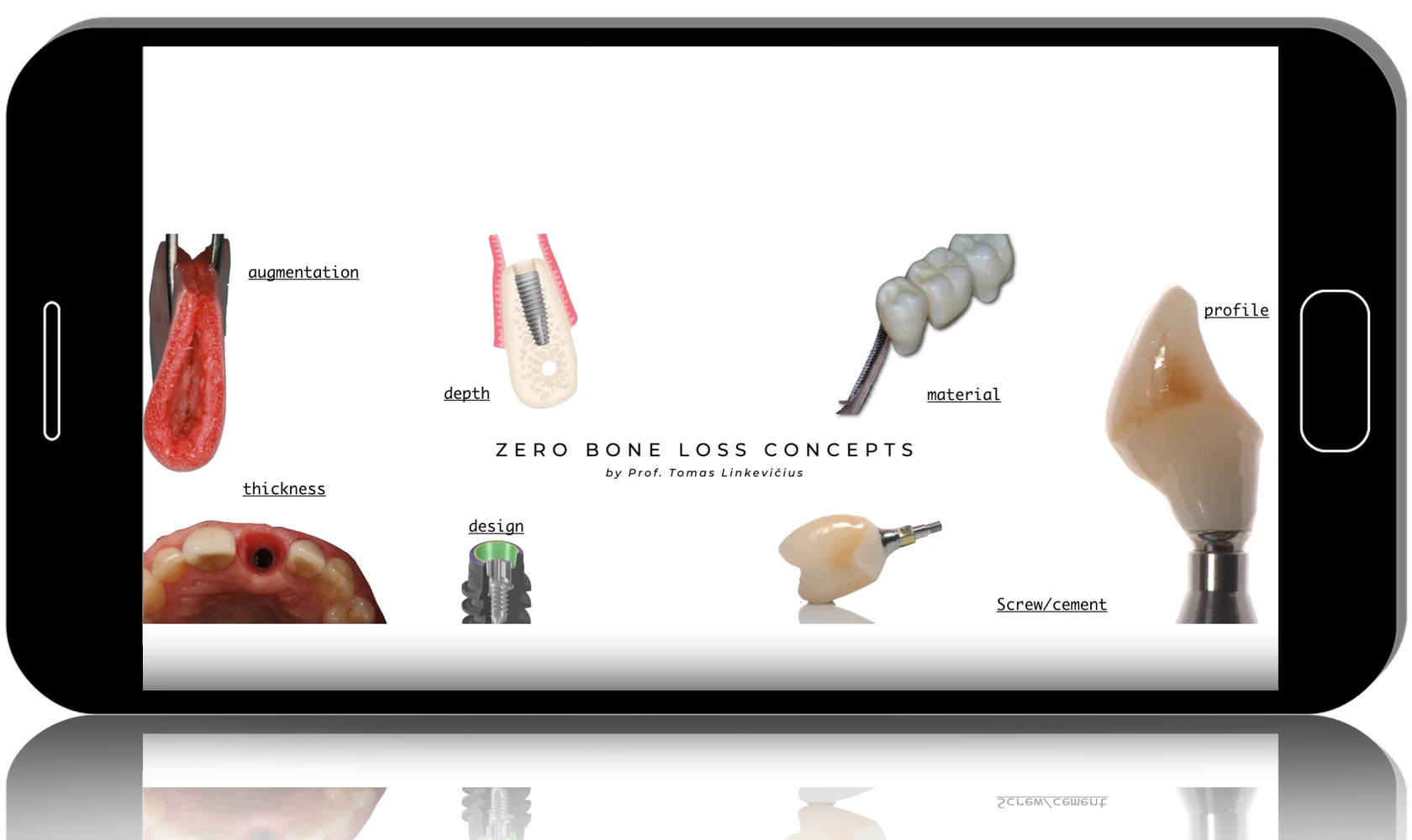 Zero Bone Loss Concepts - How to develop and maintain crestal bone sta ...